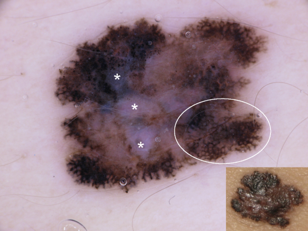 Figure 1 From Classification Of Skin Cancer Dermoscop - vrogue.co Figure 1 From Classification Of Skin Cancer Dermoscop - vrogue.co